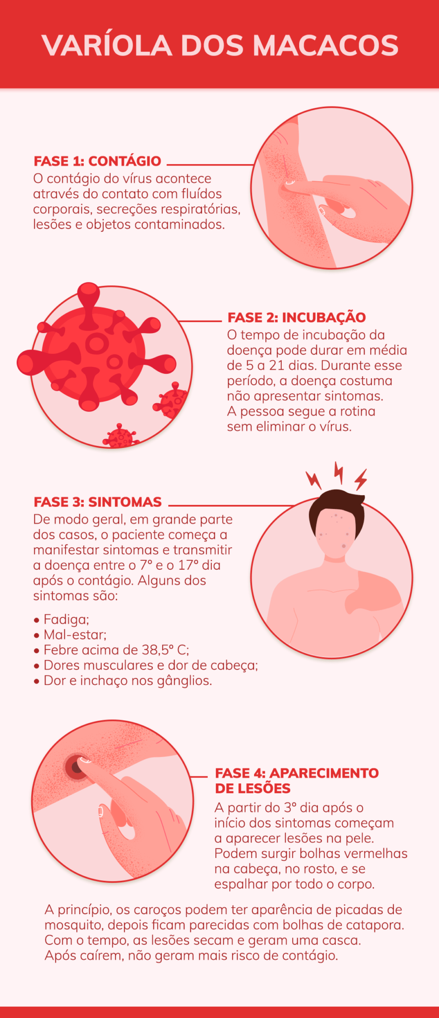 Varíola dos Macacos | Entenda os principais sintomas